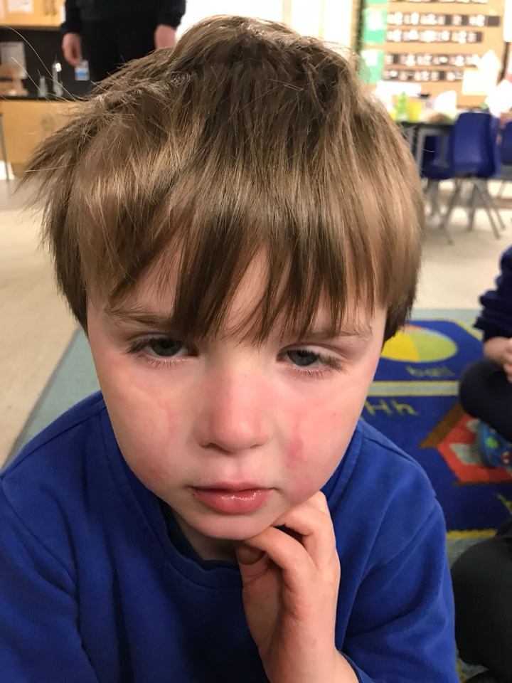 Slapped Cheek. | K9tam | Blipfoto