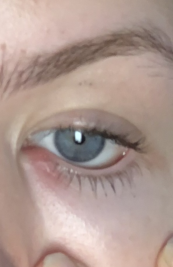 Poorly eye | GentleMummy1971 | Blipfoto