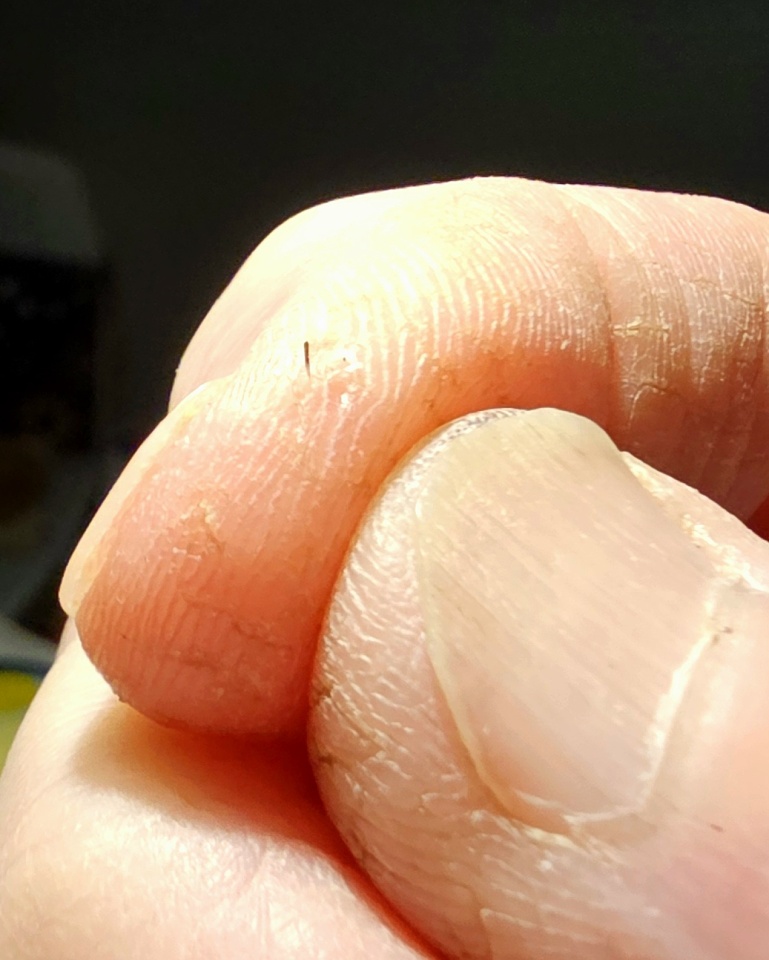 Splinter Removal | RonaldBerry | Blipfoto