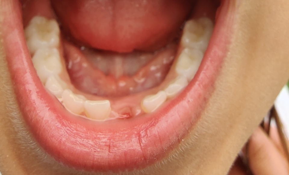 The last first tooth loss | Musimathemummer | Blipfoto